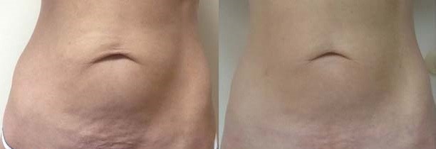 Laser Skin Tightening Treatment Melbourne - ENRICH Clinic