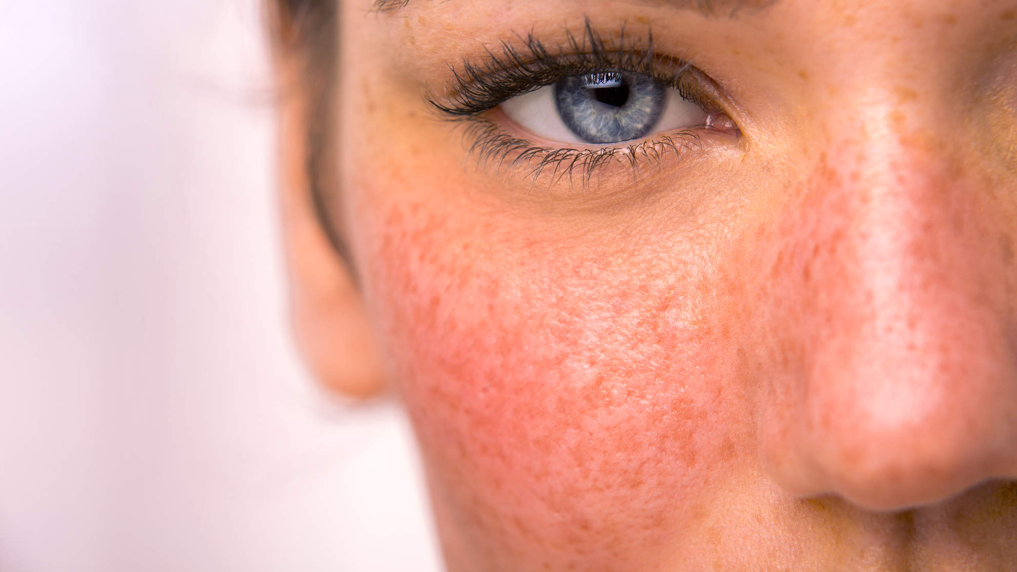 Successfully Treating Rosacea The Excel V Laser Is Best Successfully Treating Rosacea The Excel V Laser Is Best