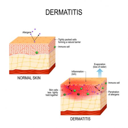 What is dermatitis & how is it related to psoriasis? | ENRICH Clinic