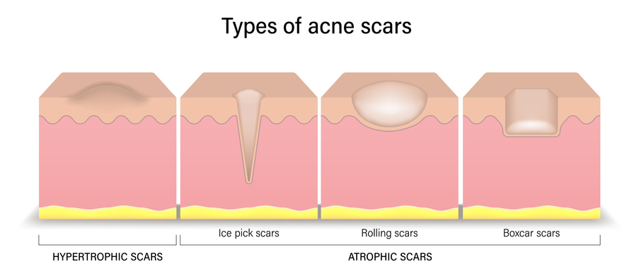 Scar Wars: A Guide to Battling Blemishes and Marks