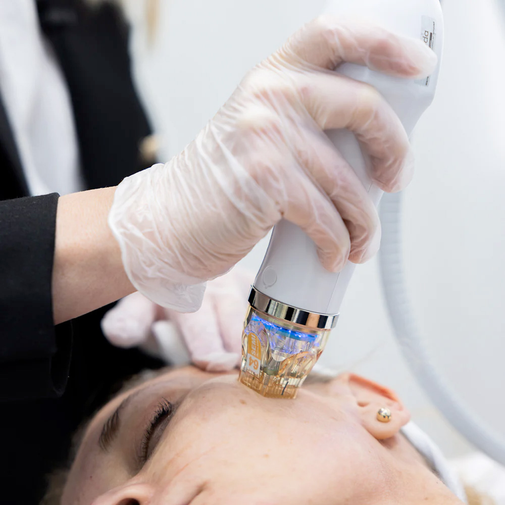 Skin needling: What can it treat, and how does it work? - Enrich Clinic