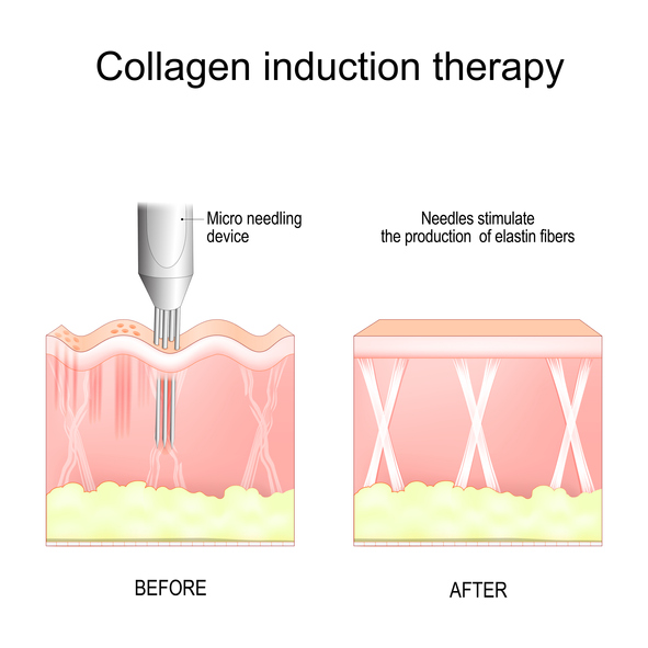 Skin needling: What can it treat, and how does it work? - Enrich Clinic