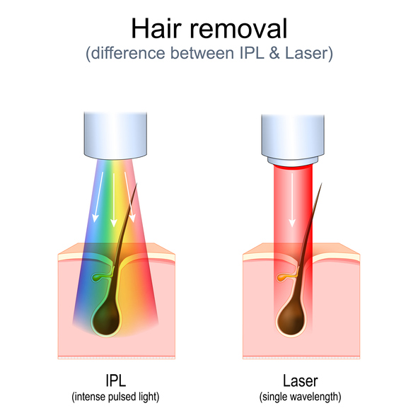 The Evolution of Intense Pulsed Light Therapy