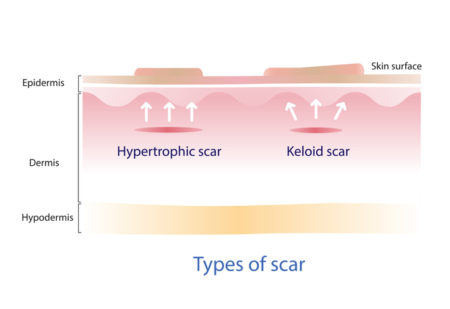 Hypertrophic scars: what are they, and will they ever go away? - Enrich ...