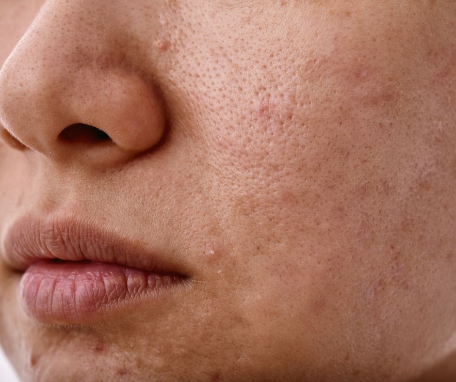How To Remove Blackheads and Other Symptoms of Skin Congestion - Enrich ...