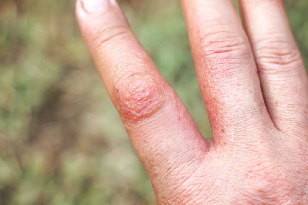 What Are Autoimmune Skin Diseases And How Do They Happen? - Enrich Clinic