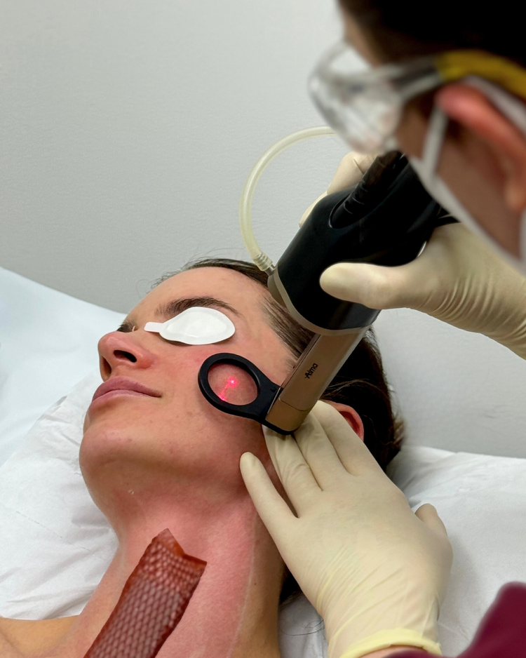 Alma Hybrid™ Laser - Enrich Clinic