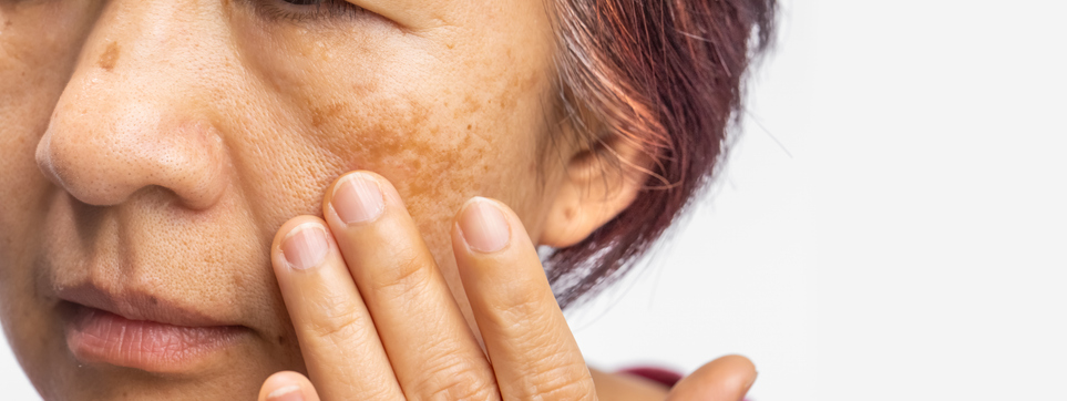 Understanding and Treating Melasma - Enrich Clinic